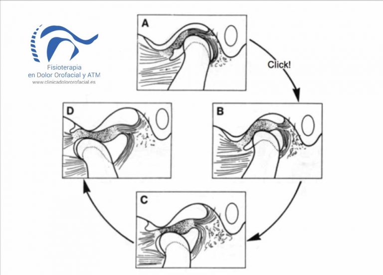 El Dolor Mandibular - Clinica Dolor Orofacial